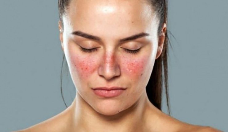 Sistemski eritemski lupus - Alfa MEDICA Poliklinika