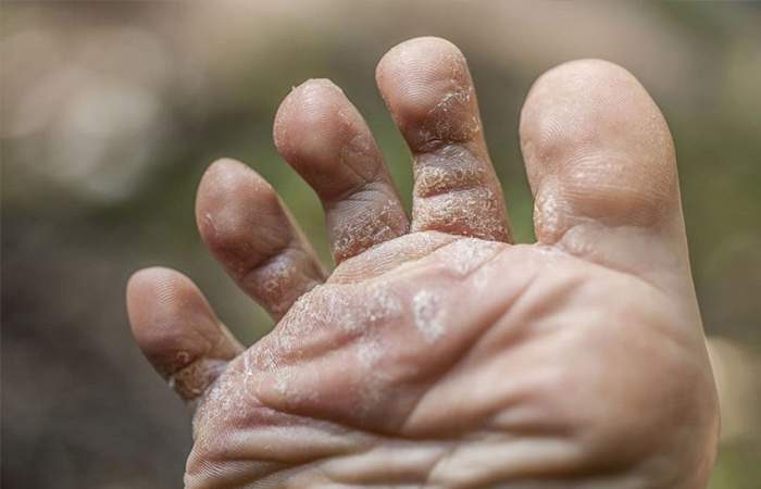 Atletsko stopalo - Alfa MEDICA Poliklinika