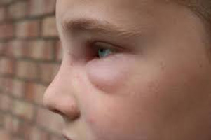 Angioedem - Alfa MEDICA Poliklinika