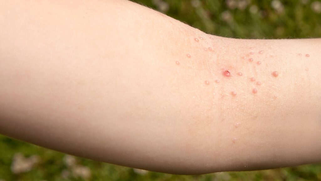 Moluske – Molluscum contagiosum - Alfa MEDICA Poliklinika